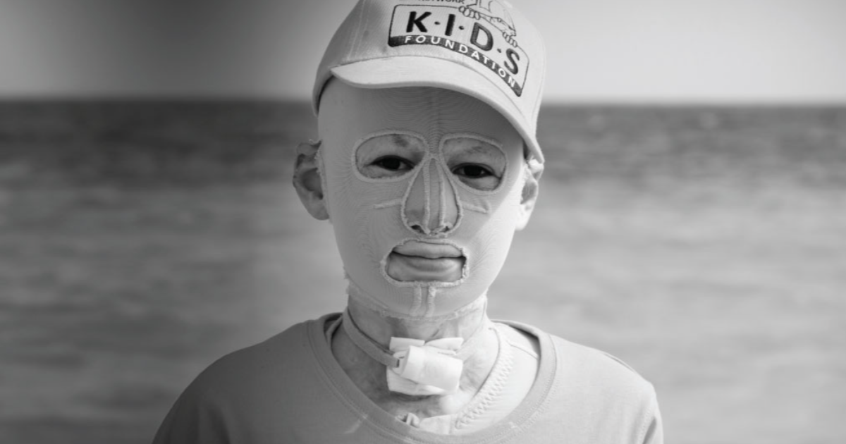 Burn Survivors Network - KIDS Foundation